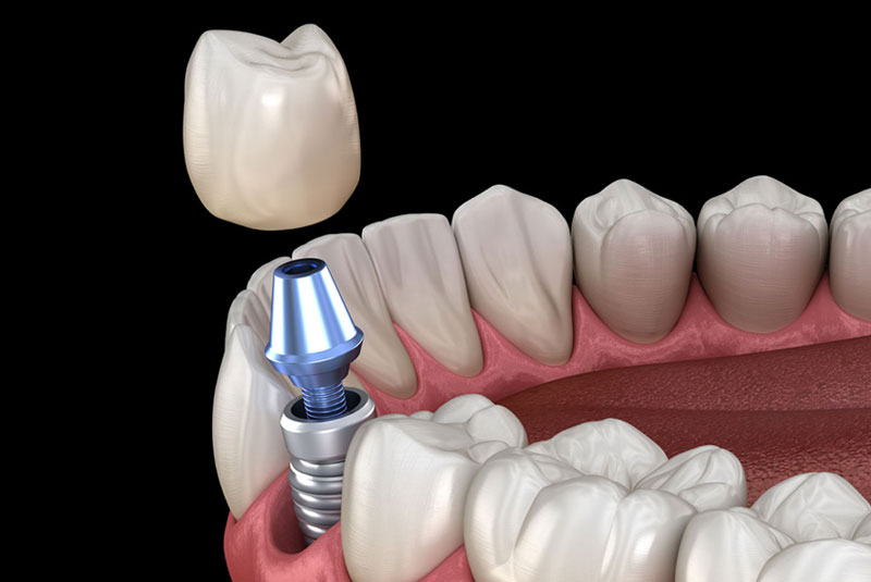 Replace Missing Teeth | Rain Dental Implant Centers